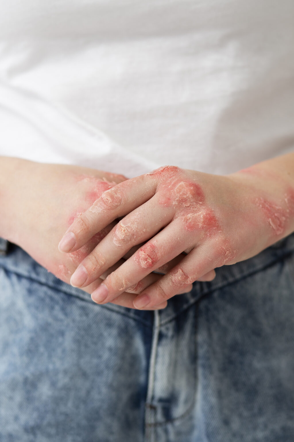 Infection à levures : causes, symptômes et traitement.