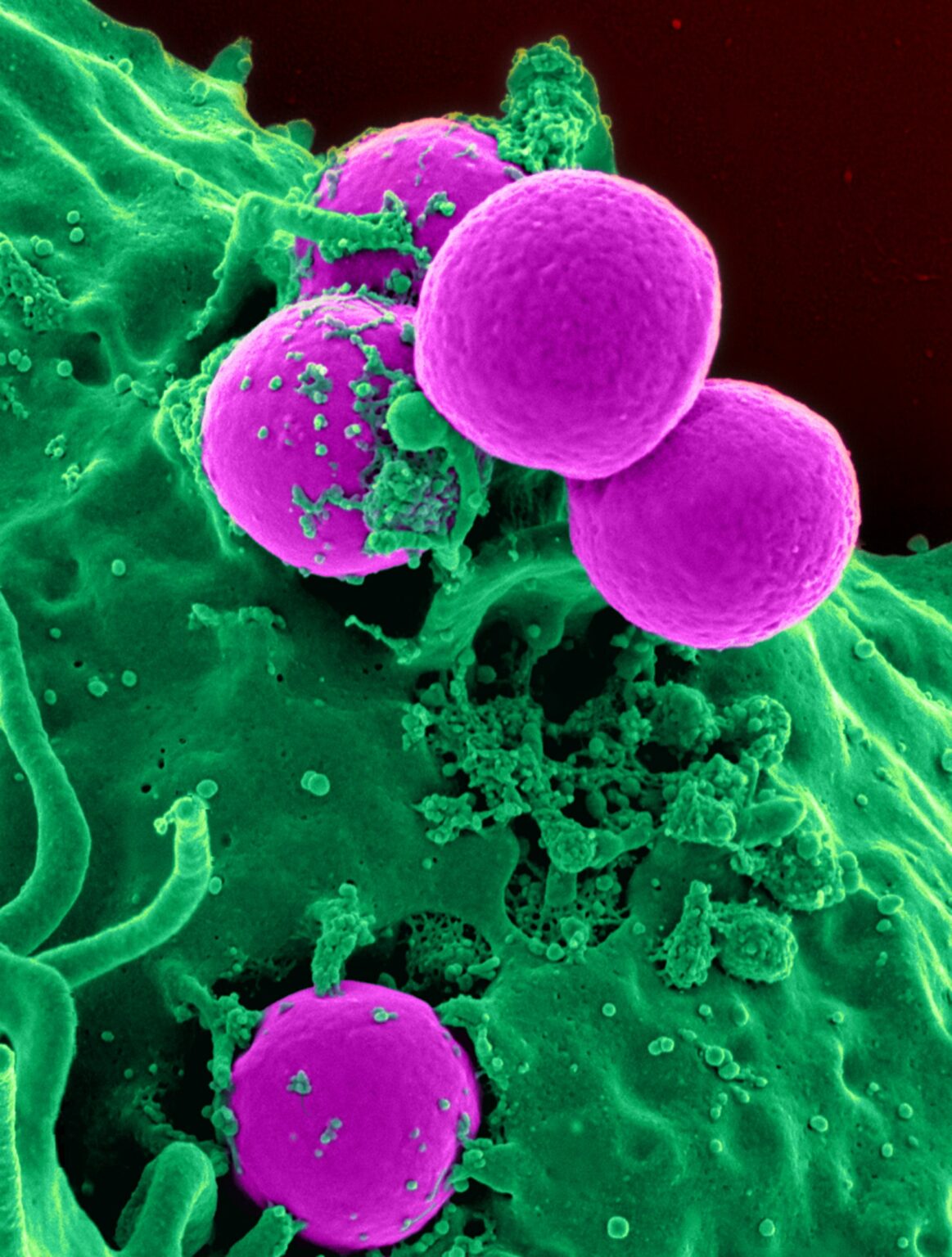 Infection à levures : causes, symptômes et traitement.